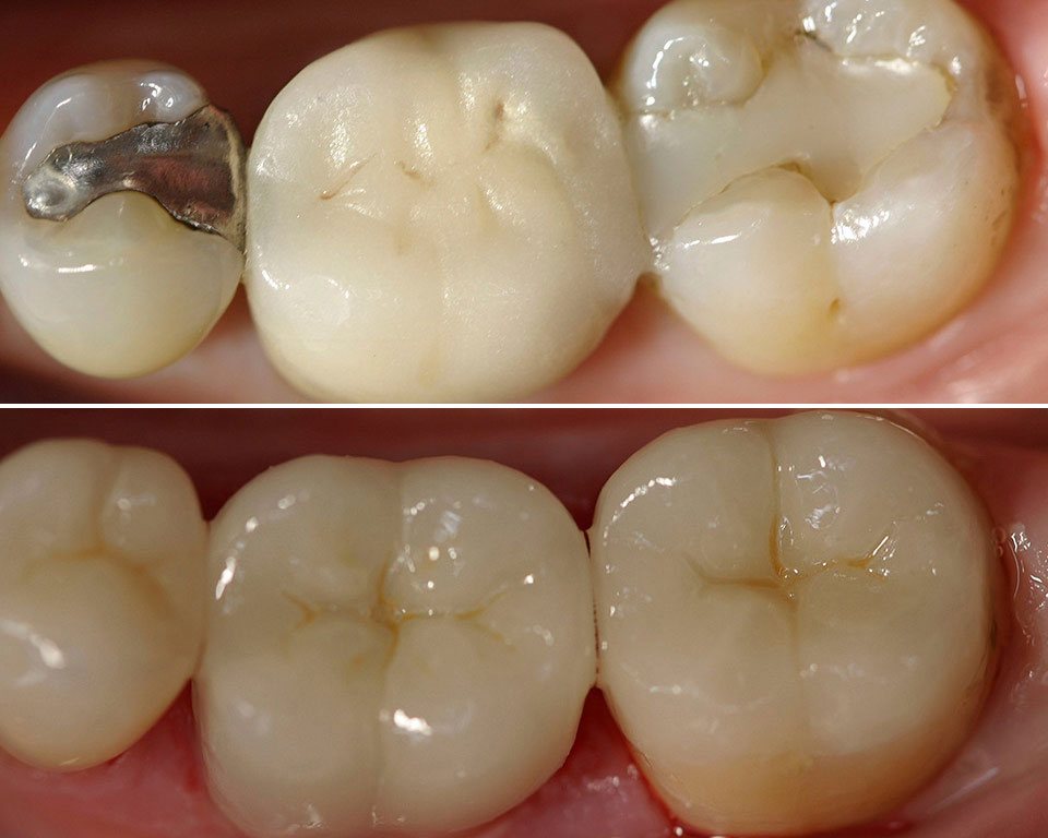 Inlay-Onlay and Overlay Fillings - Dental Treatment in Turkey - Europe ...