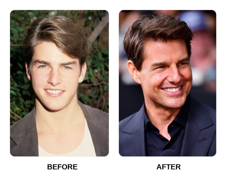 Tom Cruise Teeth Before and After: What Happened in His Transformation ...