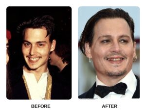 Johnny Depp Teeth Before and After: What Happened in His Transformation ...