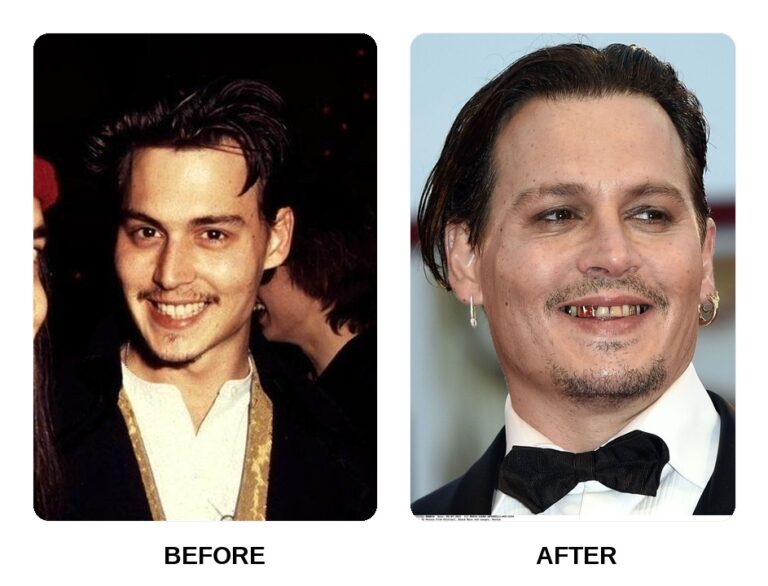 Johnny Depp Teeth Before and After: What Happened in His Transformation ...