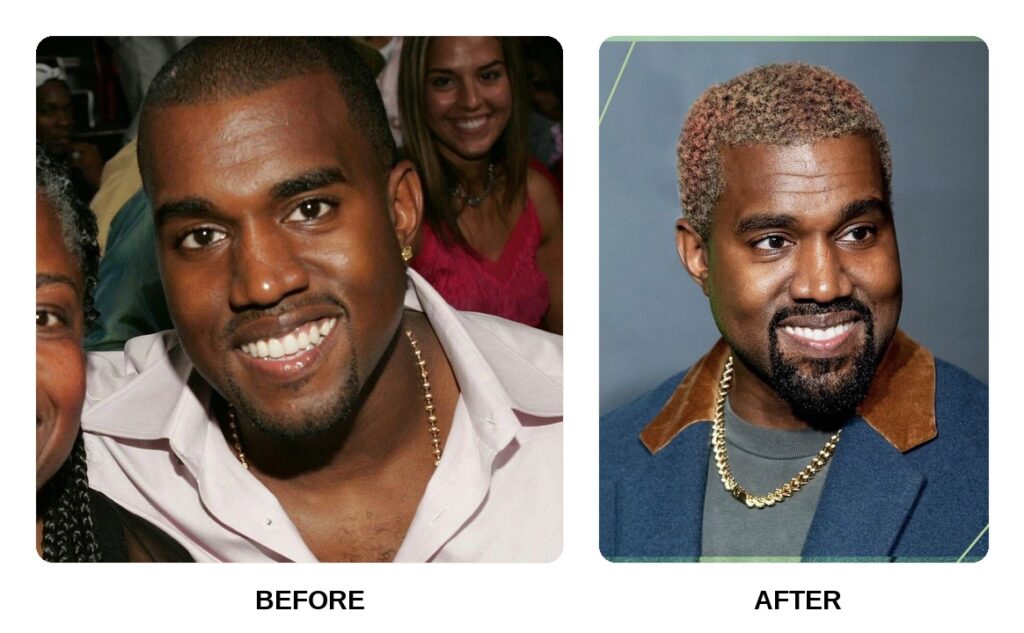 Kanye West Teeth Before and After: What Happened in His Transformation ...