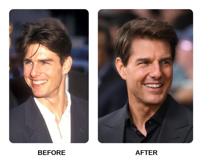 Tom Cruise Teeth Before and After: What Happened in His Transformation ...