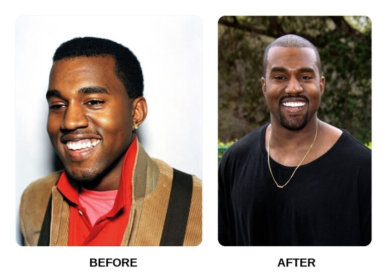 Kanye West Teeth Before And After What Happened In His Transformation 4378