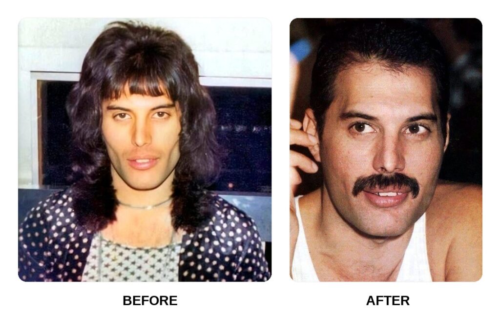 Freddie Mercury Teeth Before and After: What Happened in His ...