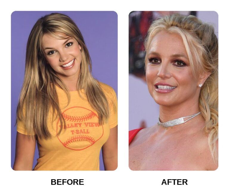 Britney Spears Teeth Before and After: What Happened in Her ...