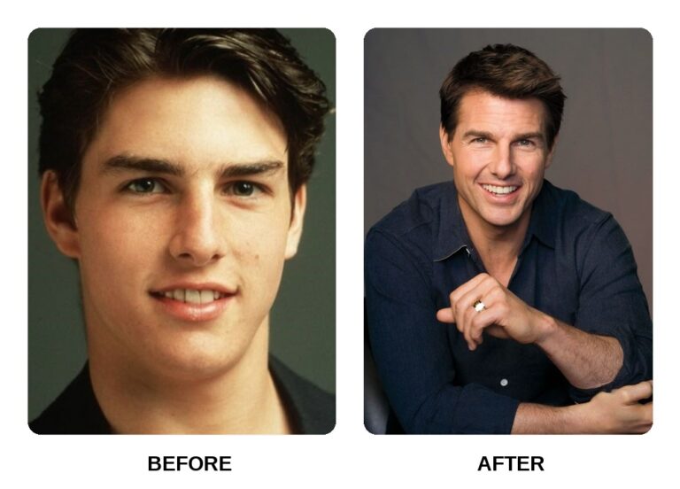 Tom Cruise Teeth Before and After: What Happened in His Transformation ...
