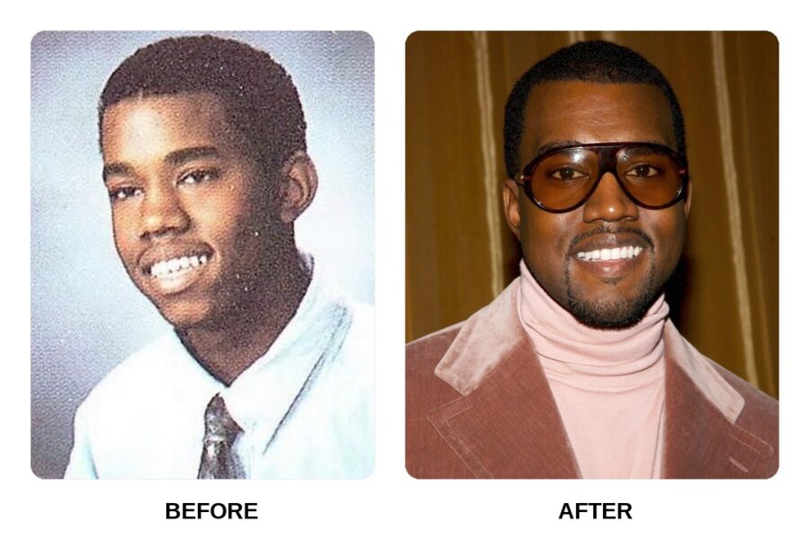 Kanye West Teeth Before And After What Happened In His Transformation 0476