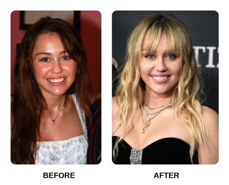 Miley Cyrus Teeth Before and After: What Happened in Her Transformation ...