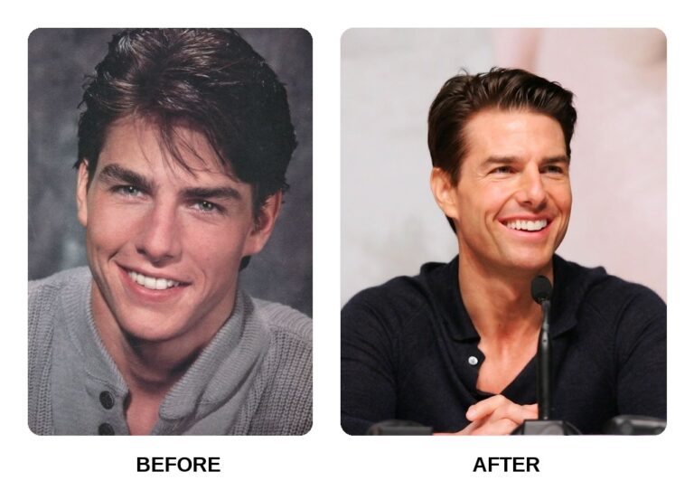 Tom Cruise Teeth Before and After: What Happened in His Transformation ...