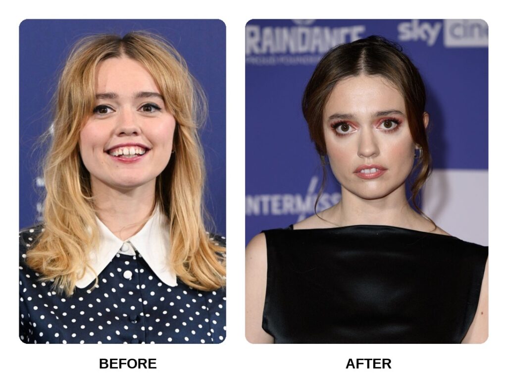 Aimee Lou Wood Teeth Before and After: What Happened in Her ...
