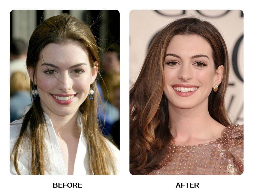 Anne Hathaway Teeth Before and After: What Happened in Her ...