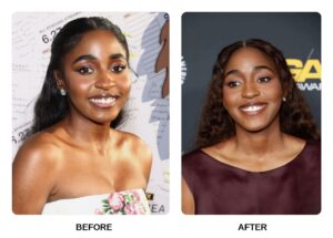 Chris Brown Teeth Before and After: What Happened in His Transformation ...