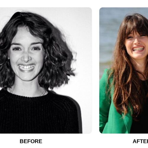 Scarlett Johansson Teeth Before and After: What Happened in Her ...