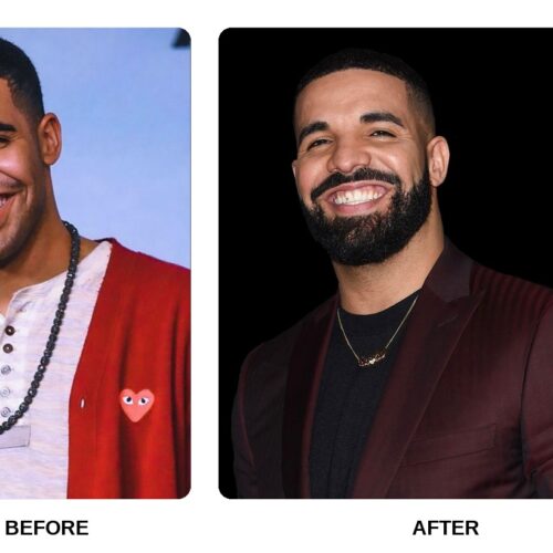 Chris Brown Teeth Before and After: What Happened in His Transformation ...