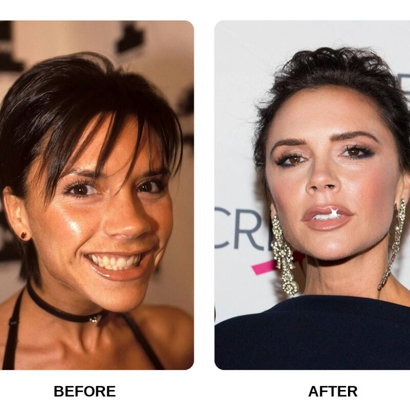 Tom Cruise Teeth Before and After: What Happened in His Transformation ...