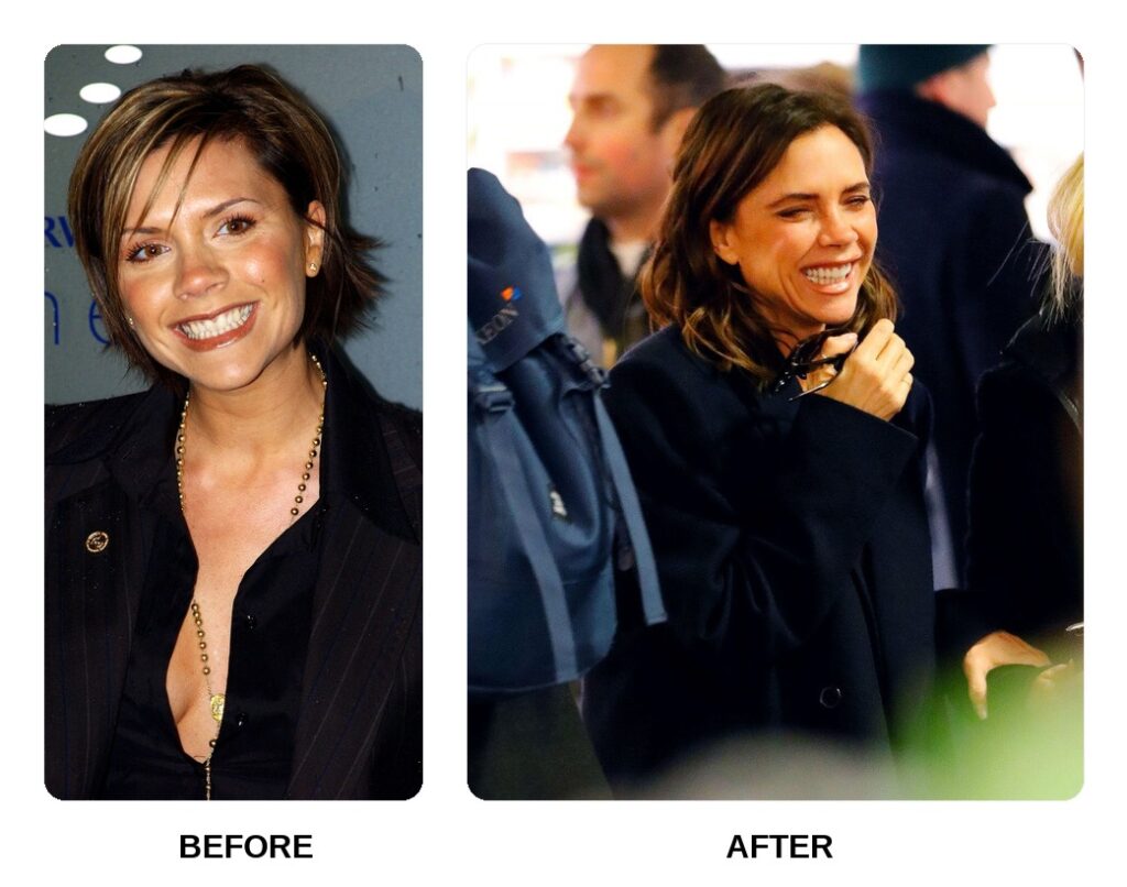 Victoria Beckham’s Teeth Before and After: What Happened in Her ...