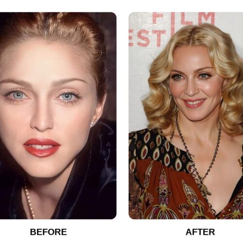 Kate Middleton Teeth Before and After: What Happened in Her ...