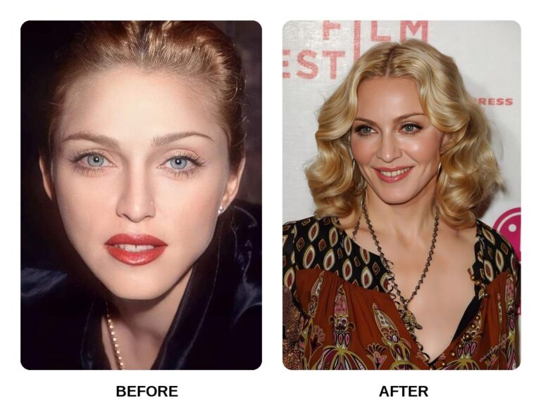 Kate Middleton Teeth Before and After: What Happened in Her ...