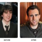 Matt Rife Teeth Before and After: What Happened in His Transformation ...