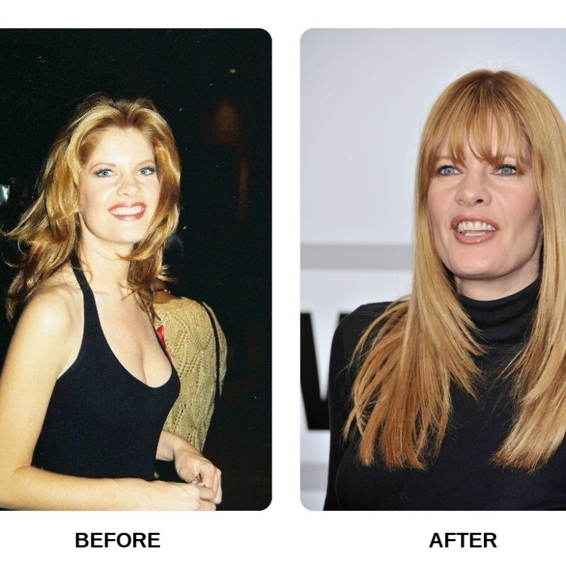 Kate Middleton Teeth Before and After: What Happened in Her ...